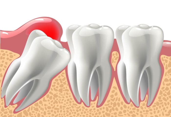 North Oklahoma Oral Surgeon Discusses Impacted Wisdom Teeth